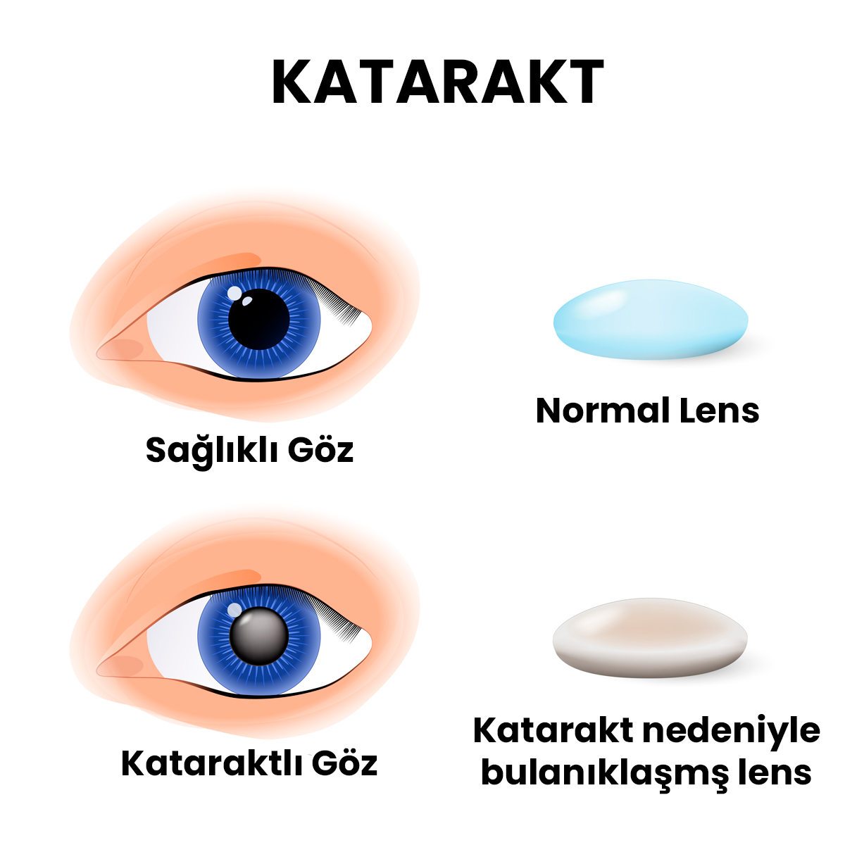 Katarakt Tedavileri Nelerdir? Belirtileri Nedir?