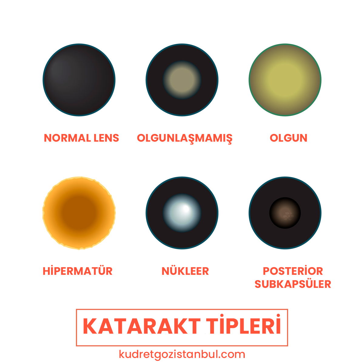 Katarakt Tedavileri Nelerdir? Belirtileri Nedir?