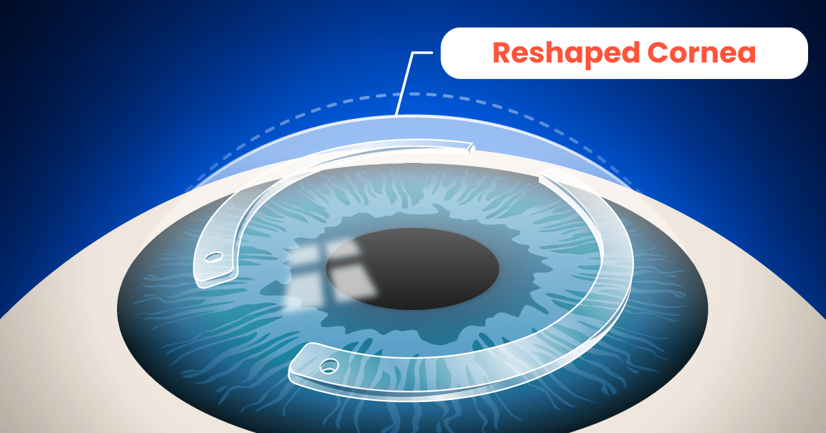 Corneal Ring Implantation - Kudret Göz İstanbul