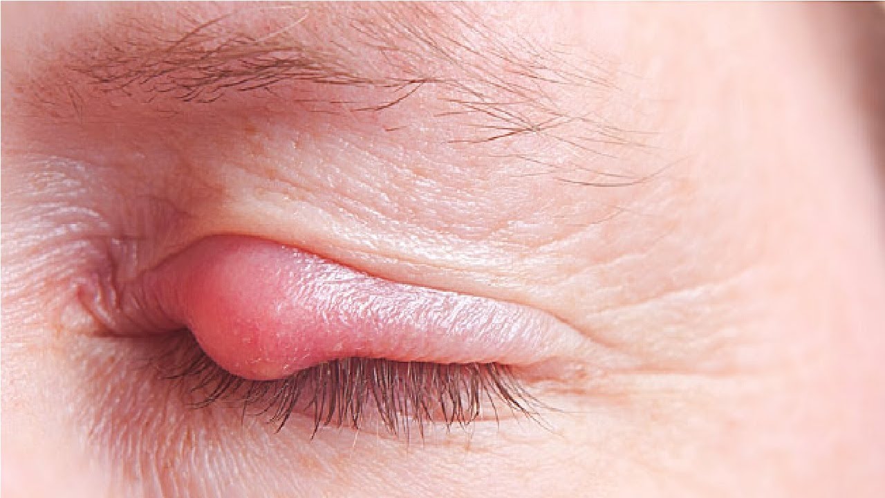 Arpacık Kaç Günde Geçer - Kudret Göz İstanbul